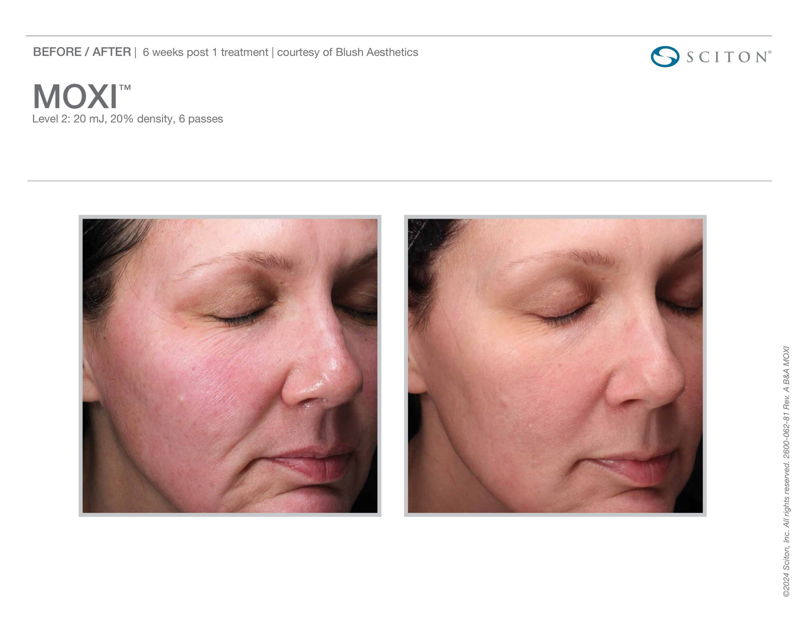 What to Expect from MOXI® and BBL® HEROic™ – Your Complete Guide to Modern Skin Rejuvenation ...